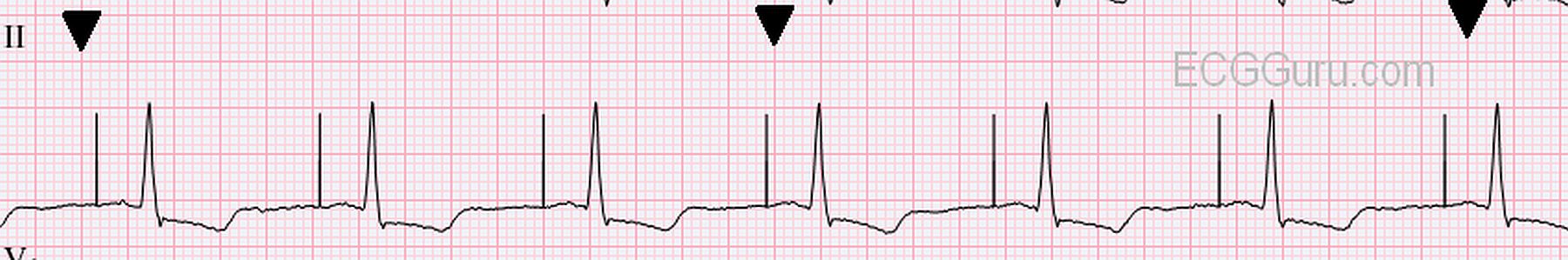 Ecg Basics Atrial Pacing Ecg Guru Instructor Resources